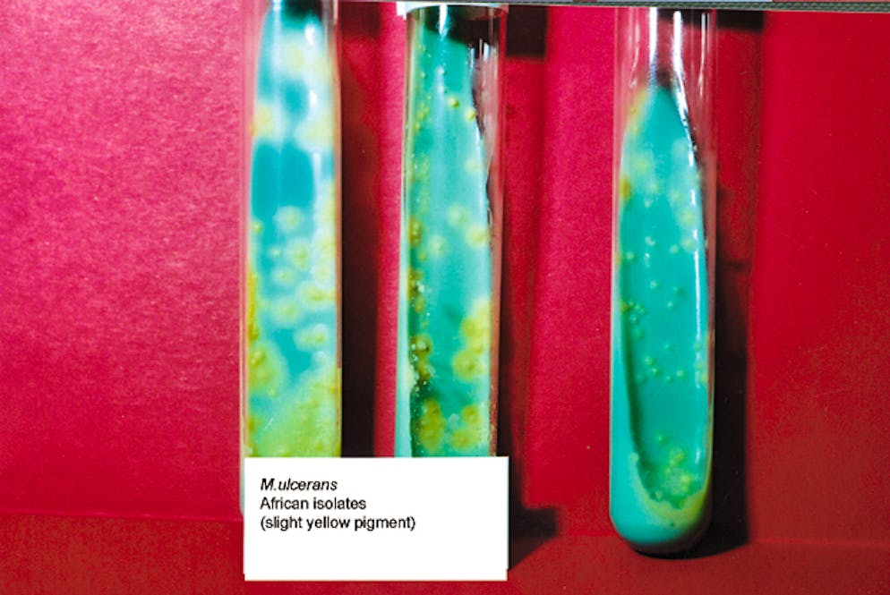 Buruli-Ulkus: «Fleischfressendes Geschwür» grassiert in Australien