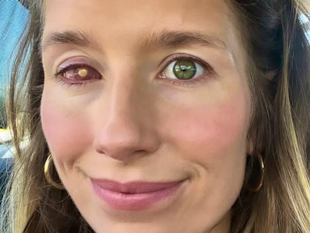 Influencer goes blind - because she showers with contact lenses | blue News