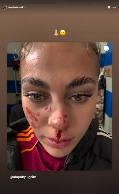 Nati star Alayah Pilgrim breaks her nose and is out of action | blue News