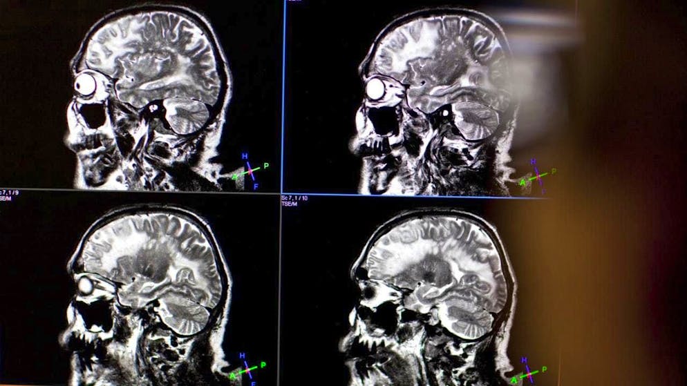 Medicine: Geneva researchers find new approach to combat schizophrenia ...