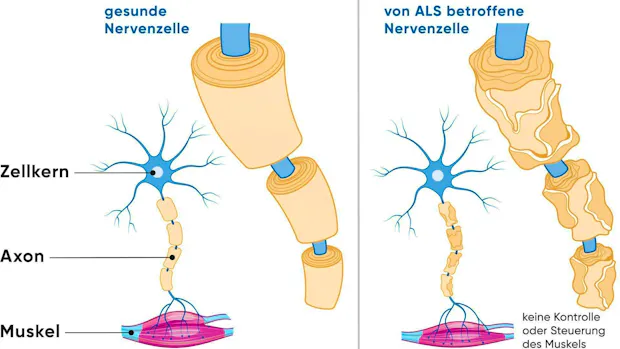 What is ALS? Disease, symptoms and progression explained | blue News