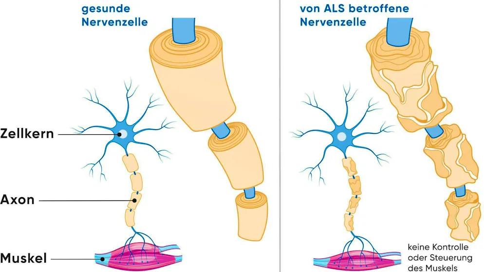 What is ALS? Disease, symptoms and progression explained | blue News